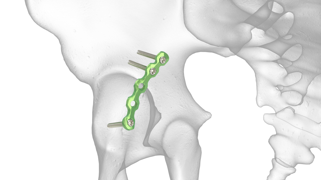 Pelvic Plating System | Acumed