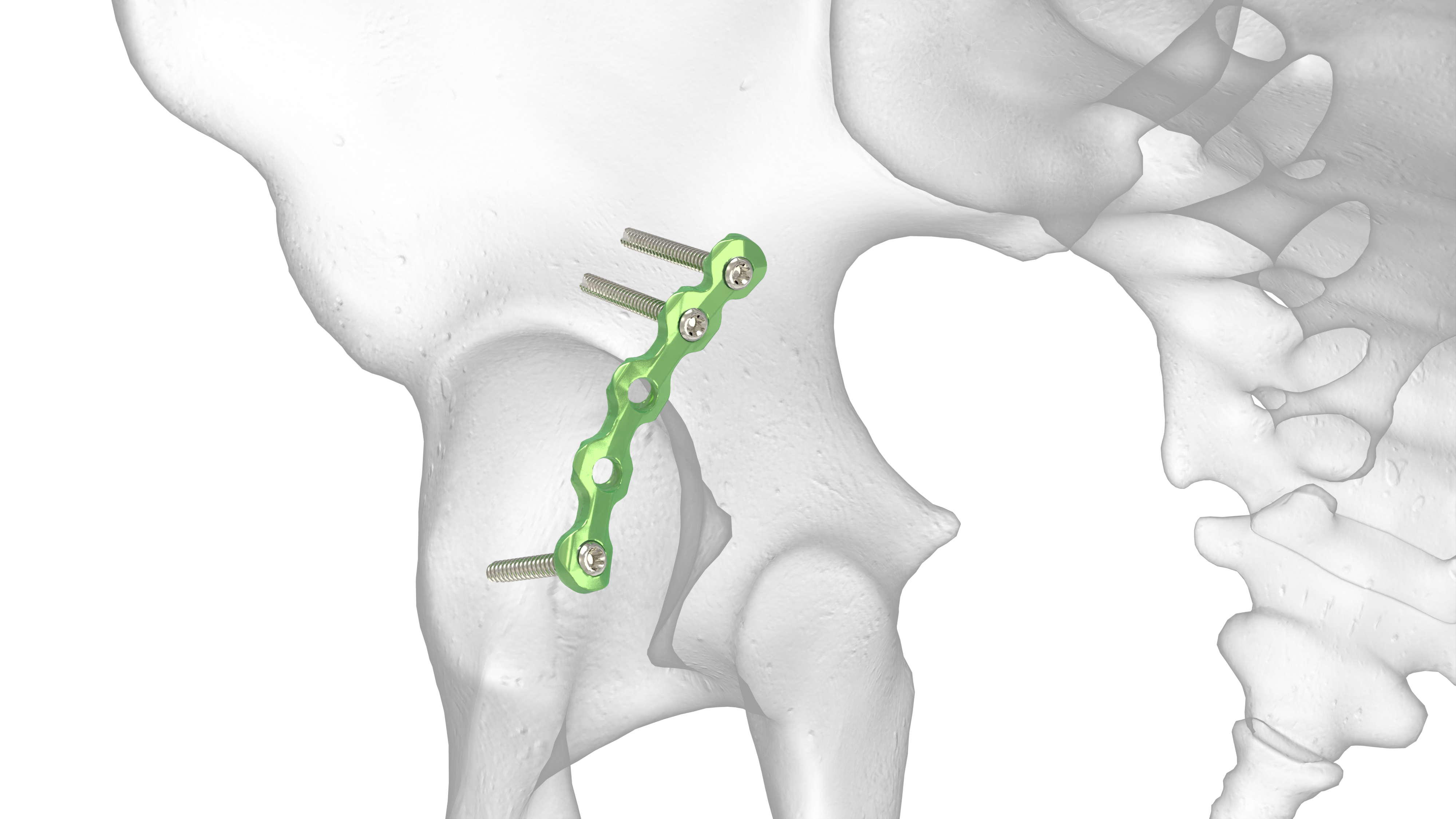 Intra-Pelvic Plate | Acumed