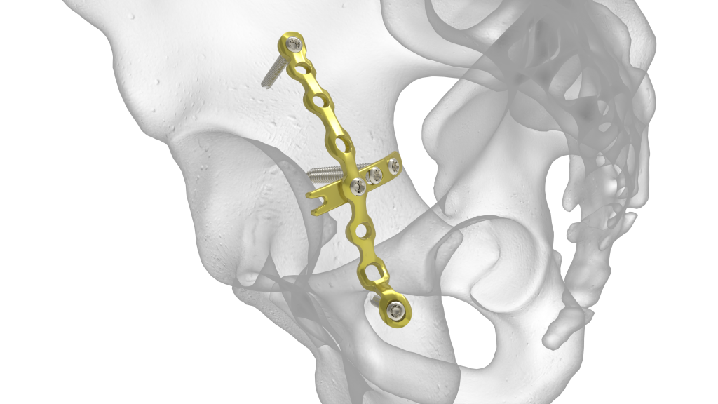 Pelvic Plating System | Acumed