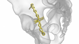 Pelvic Plating System | Acumed