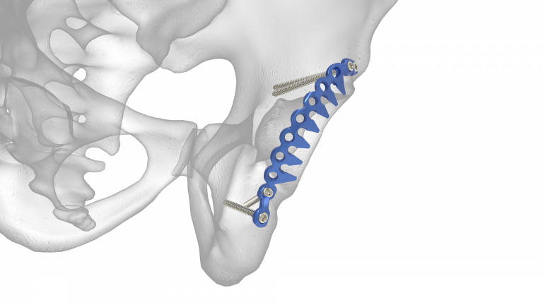 Posterior Wall Acetabular Fragment Plate | Acumed
