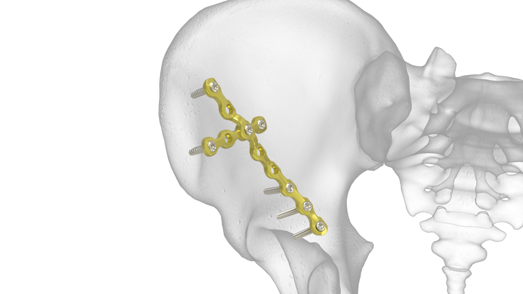Pelvic Plating System | Acumed