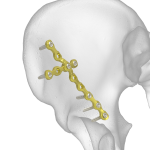 Pelvic Plating System | Acumed