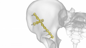 Pelvic Plating System | Acumed