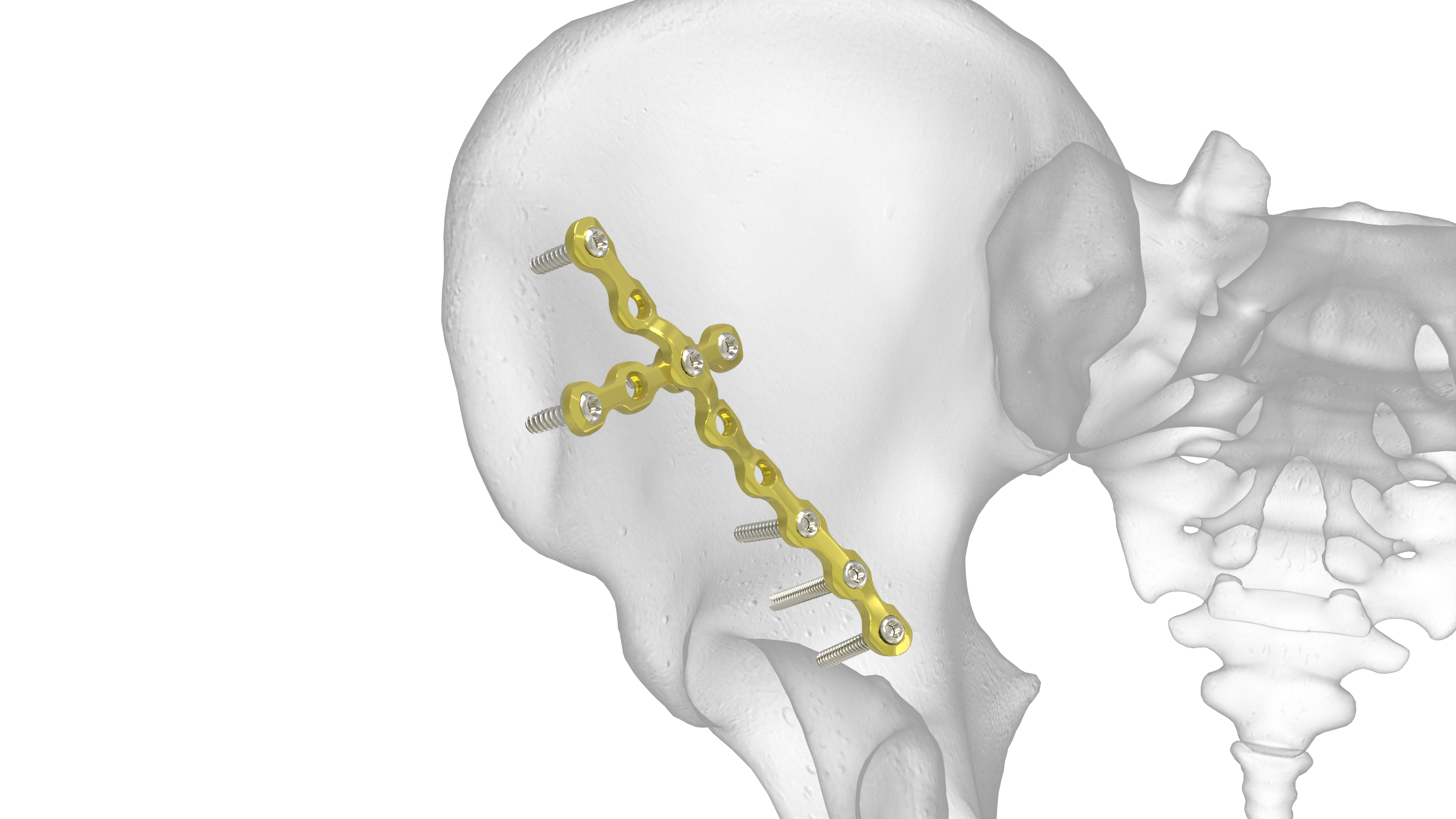 Pelvic Plating System | Acumed