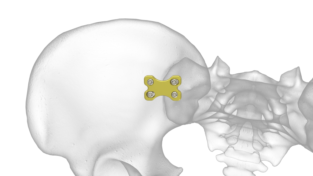Pelvic Plating System | Acumed