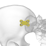 Pelvic Plating System | Acumed