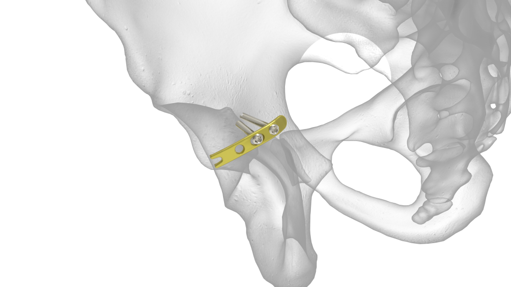 Pelvic Plating System | Acumed