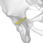 Pelvic Plating System | Acumed