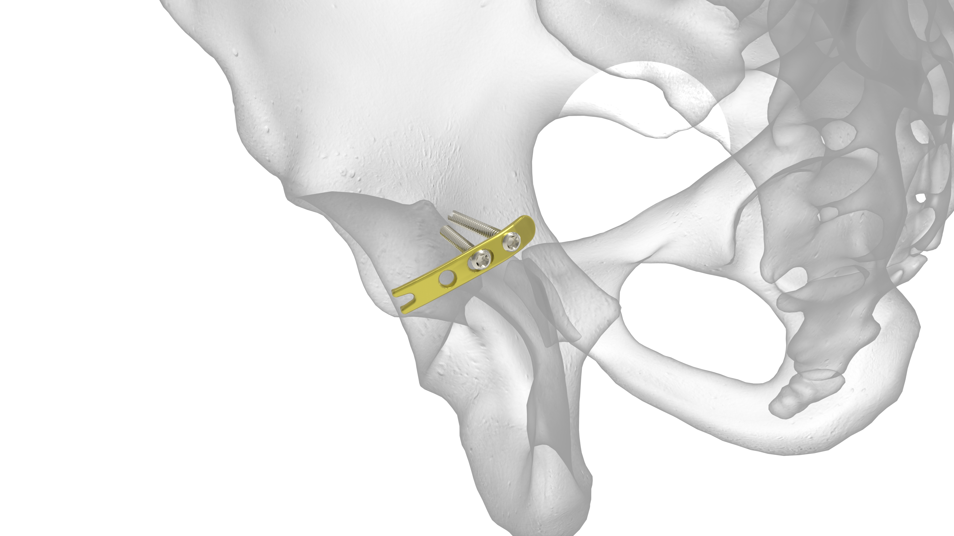 Acetabular Spring Plate | Acumed