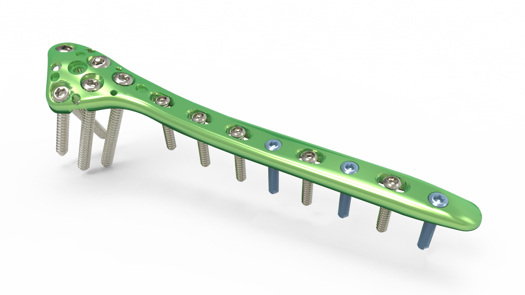 Polarus Proximal Humeral Plating System | Acumed