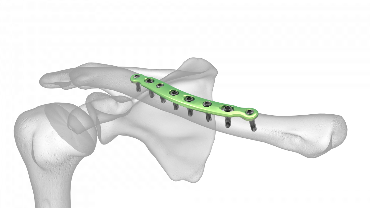Midshaft Clavicle Plate | Acumed