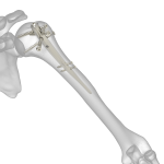 Polarus Humeral Rod System | Acumed