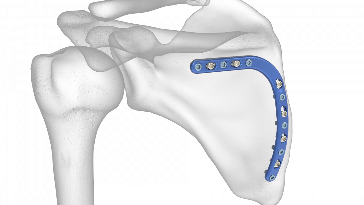Medial Border Plate | Acumed