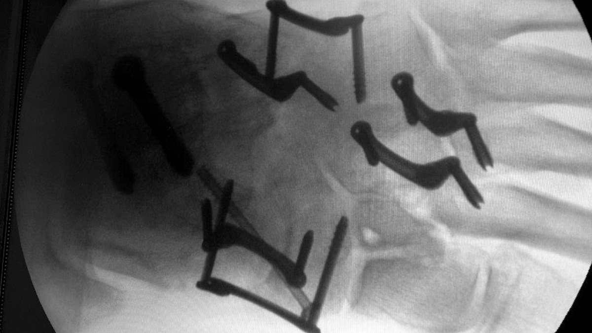 Tarsal metatarsal fusion, Dorsal view | Acumed