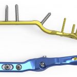 Total Wrist Fusion Plating System | Acumed