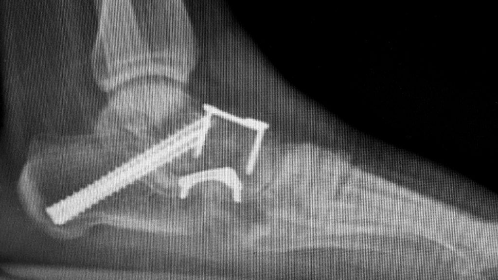 Triple Arthrodesis_2 | Acumed