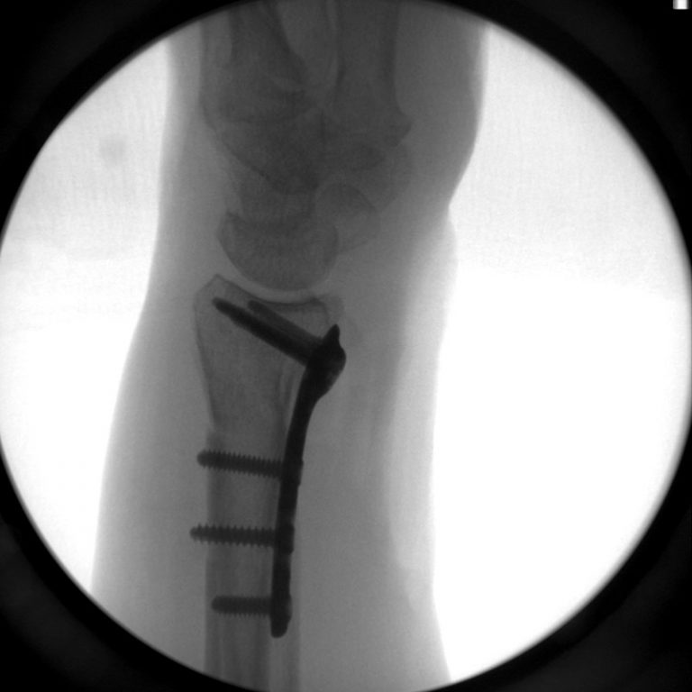 Acu-Loc Wrist Plating System | Acumed