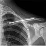 Dual-Trak Clavicle Screw System | Acumed