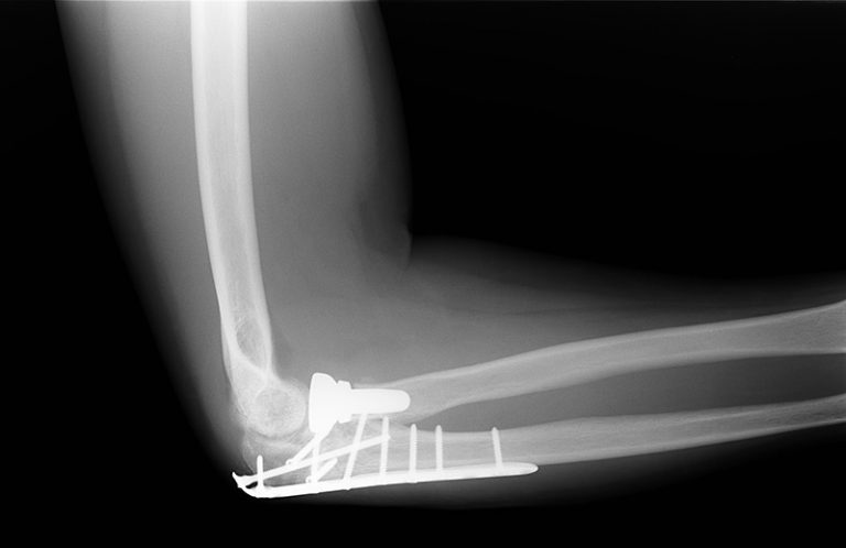Elbow Plating System | Acumed