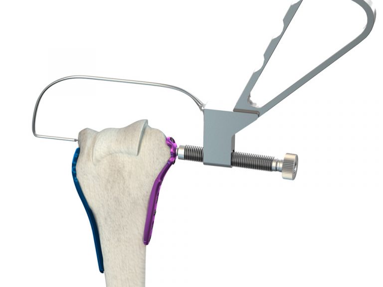 Elbow Plating System | Acumed