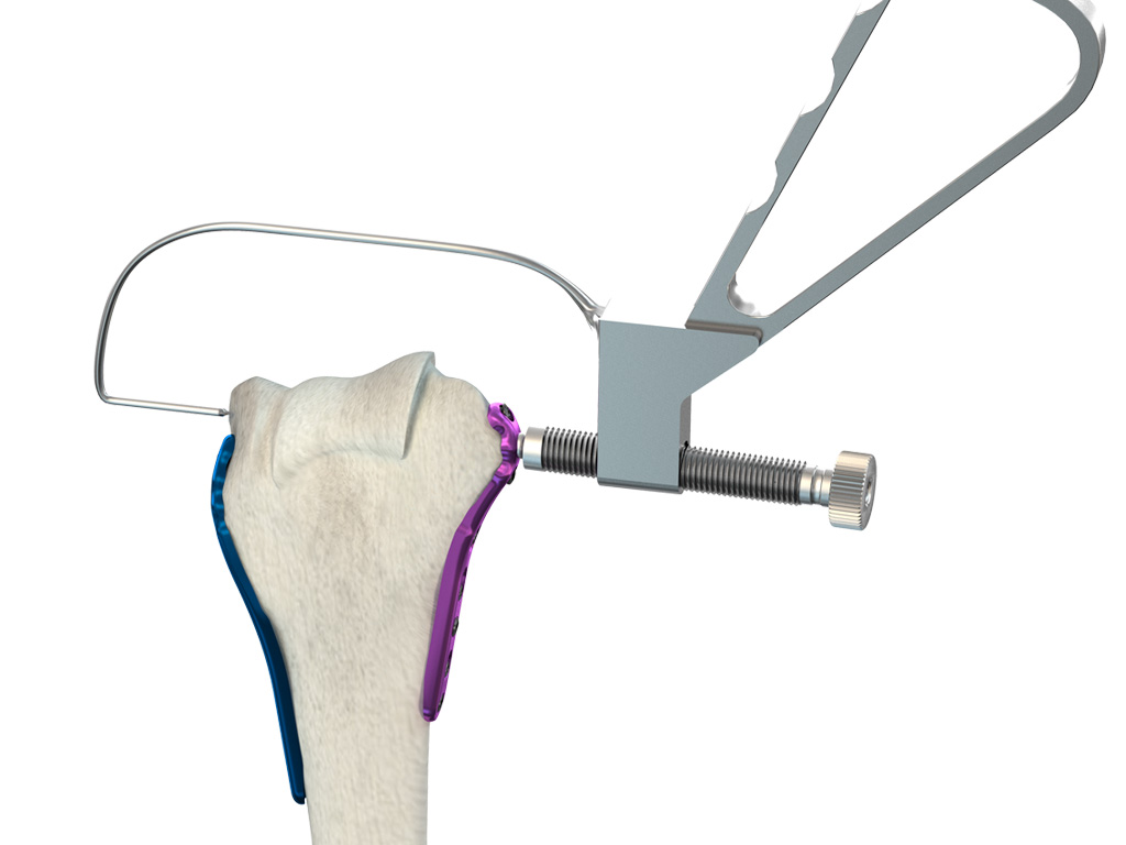 Elbow Plating System | Acumed