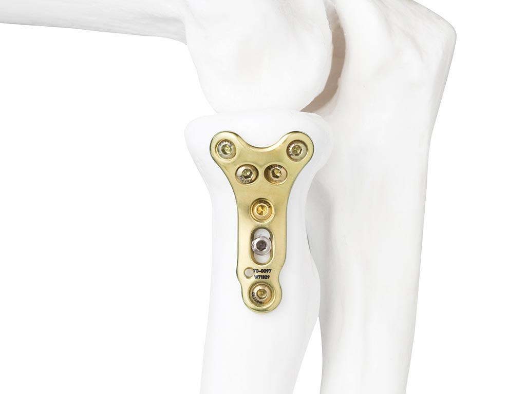 Radial Head Plate | Acumed