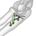Elbow Plating System | Acumed