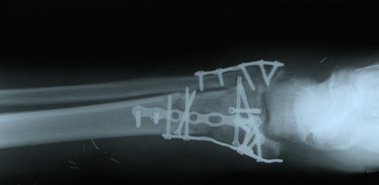 Calcaneal Plating System | Acumed