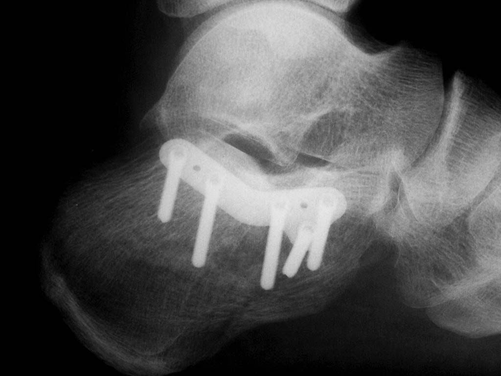 Calcaneal Plating System | Acumed