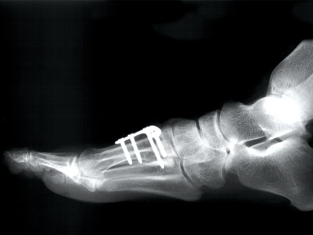 Forefoot/Midfoot Plating System | Acumed