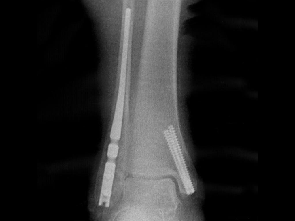 Fibula Rod System | Acumed