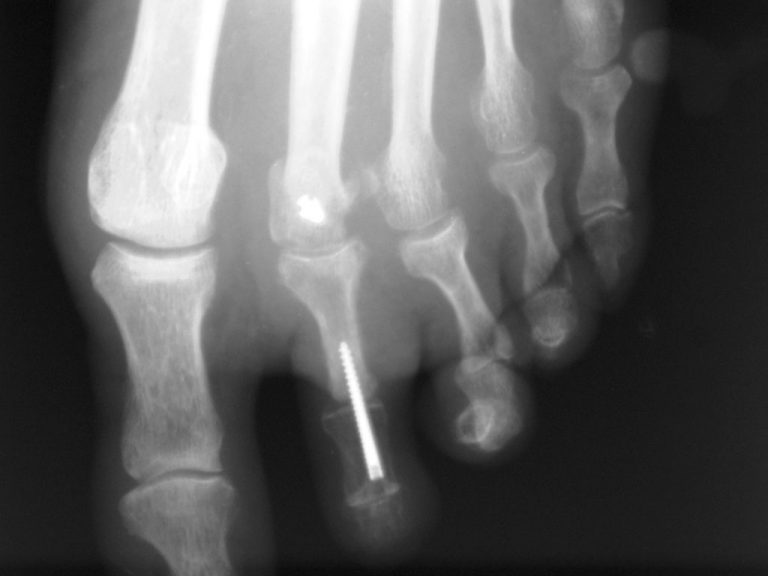 Hammertoe Fusion System | Acumed