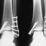 Ankle Plating System | Acumed