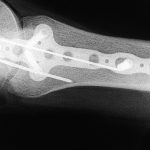 Ankle Plating System | Acumed