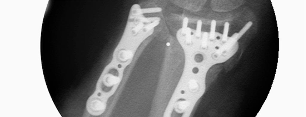 Acu-Loc Wrist Plating System | Acumed