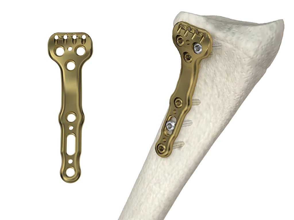 Acu Loc Wrist Plating System Acumed