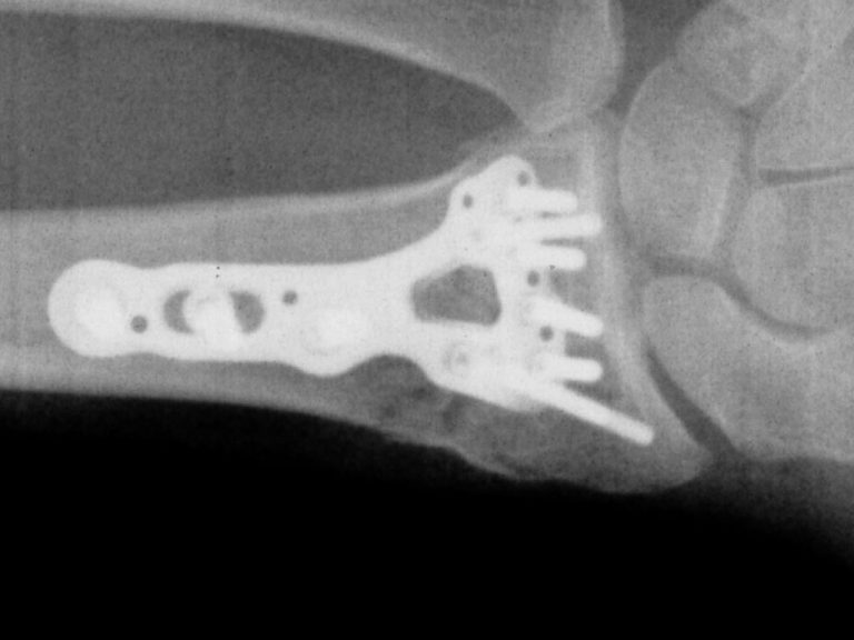 Acu-Loc 2 Wrist Plating System | Acumed
