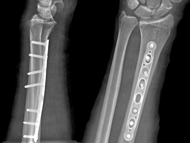 Anatomic Midshaft Forearm Plating System | Acumed