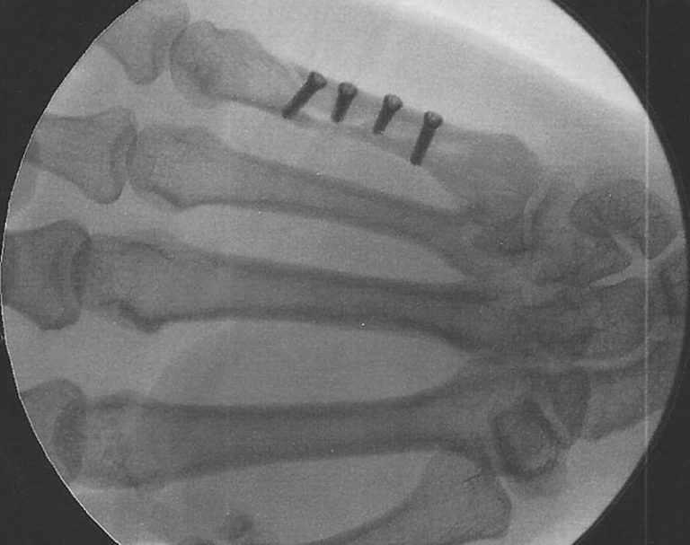 Hand Fracture System | Acumed