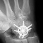 Modular Hand System | Acumed