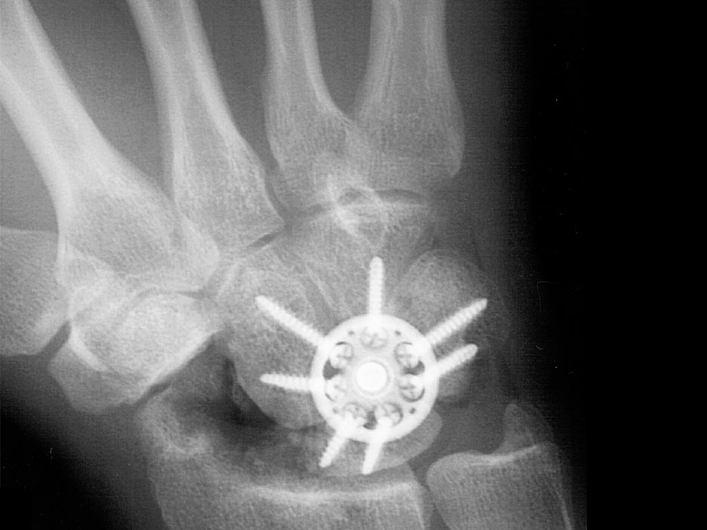 Modular Hand System | Acumed