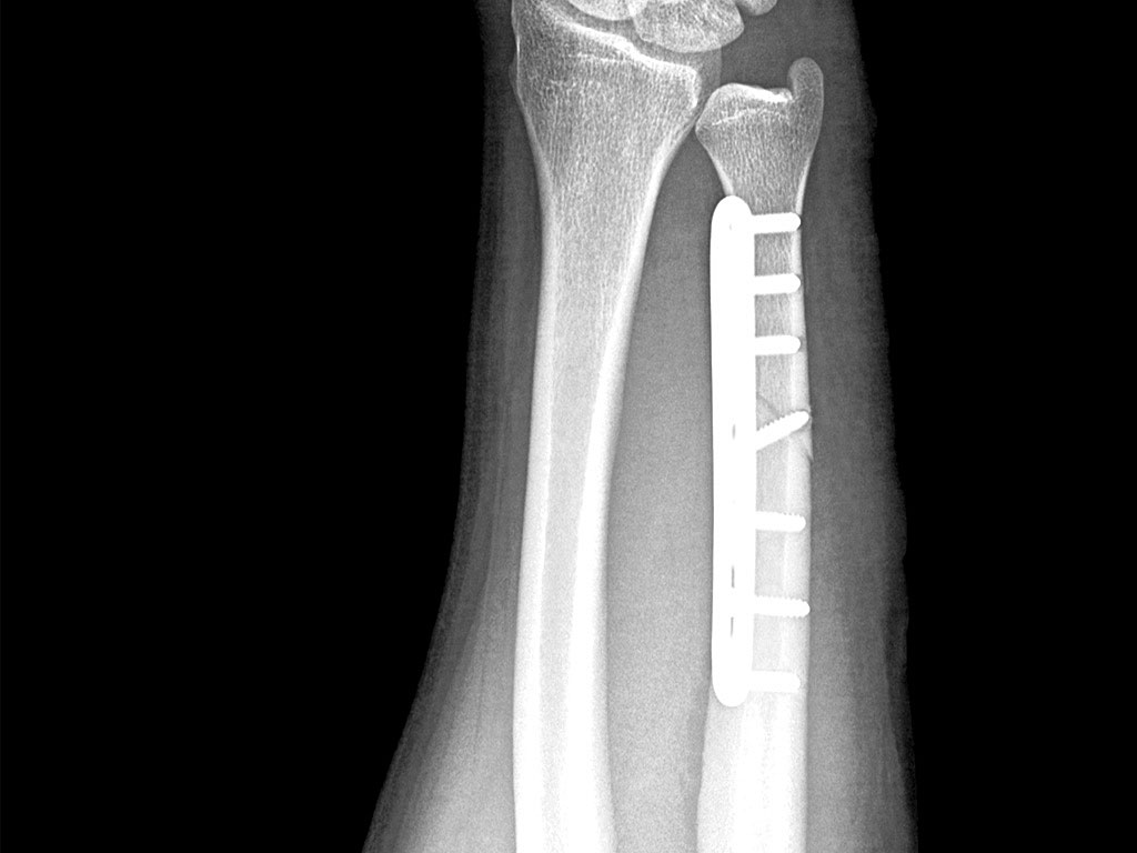 Osteotomy System | Acumed