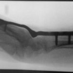 Total Wrist Fusion Plating System | Acumed