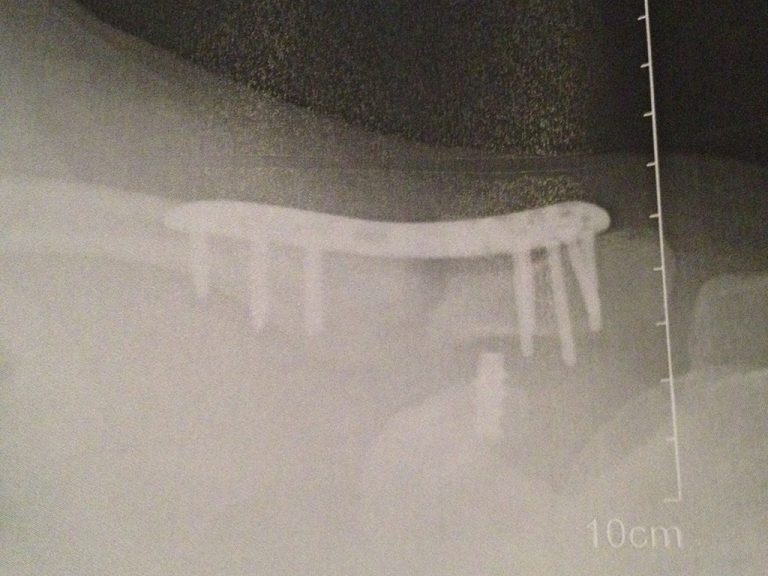 Acu-Sinch Repair System | Acumed