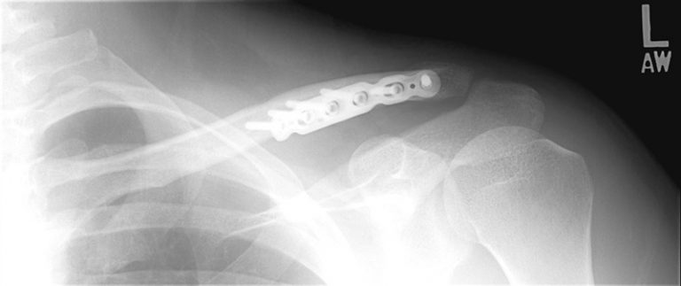 Clavicle Plating System | Acumed