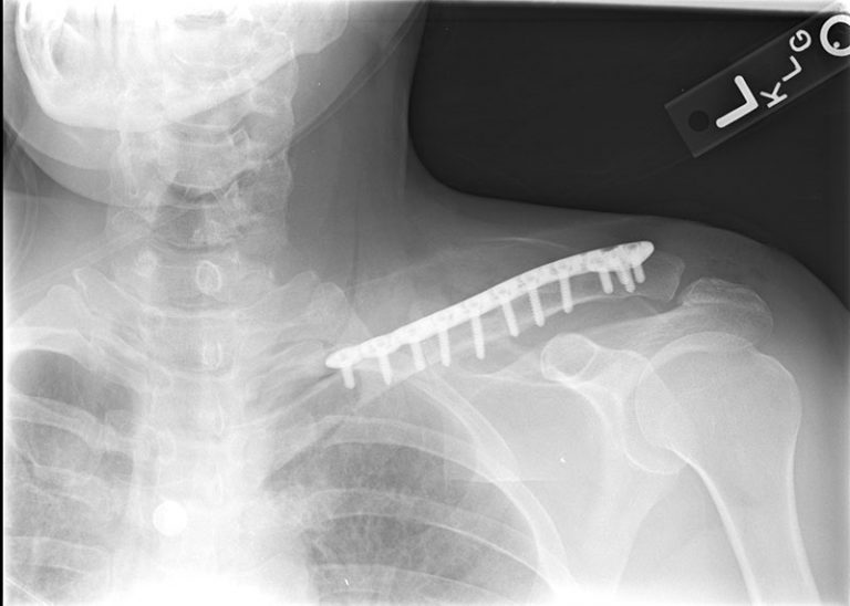 Clavicle Plating System | Acumed