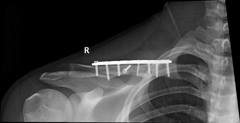 Clavicle Plating System | Acumed