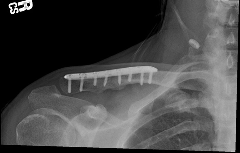 Clavicle Plating System | Acumed