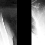 Polarus Humeral Rod System | Acumed